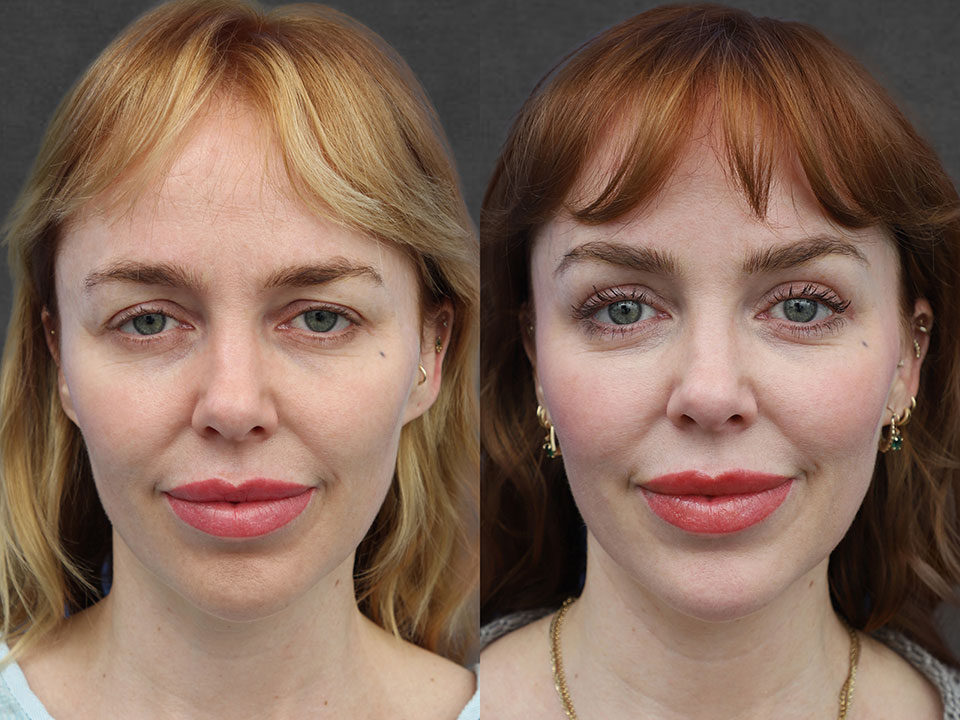Forehead/Brow Lift Surgery Los Angeles | Beverly Hills